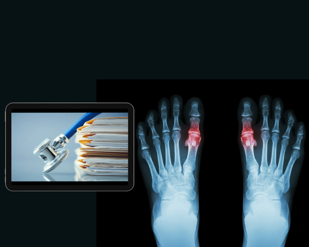 Gout Management Mini-Audit: Reflect and Improve Patient Care