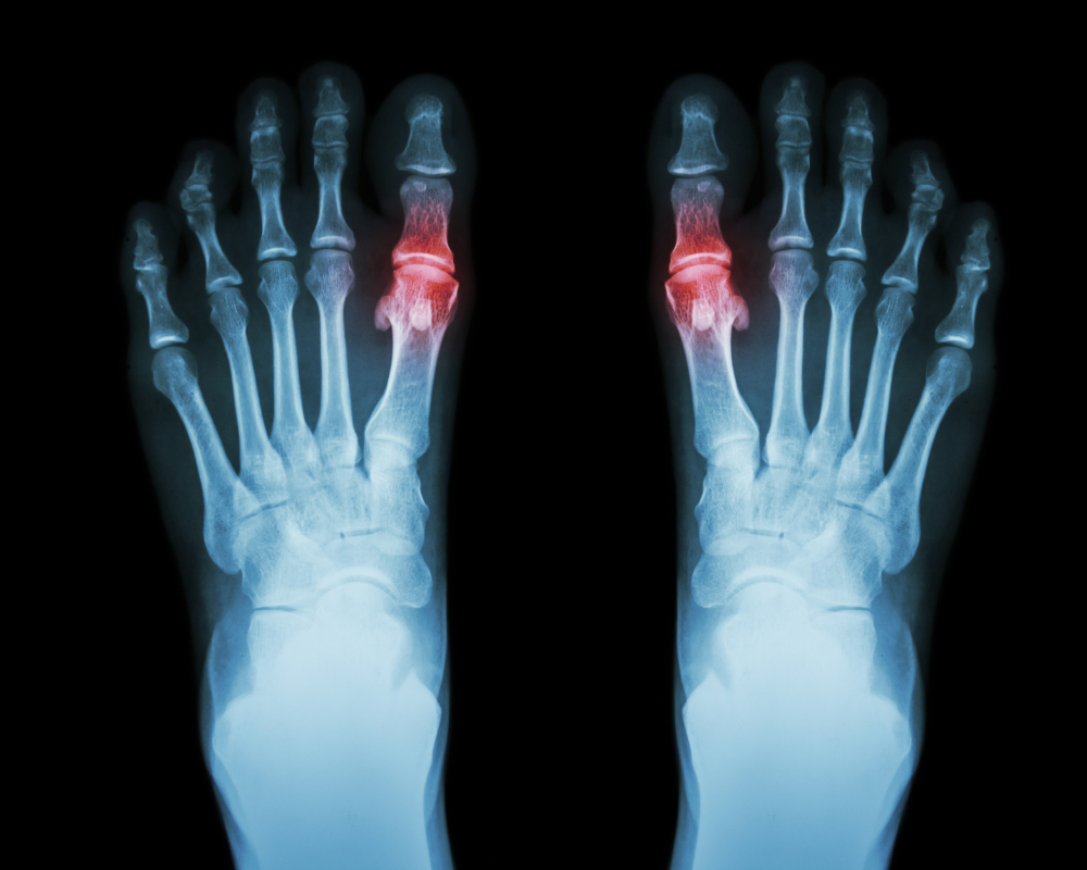 Best Practice Approach to Managing Gout Webinar | Medcast