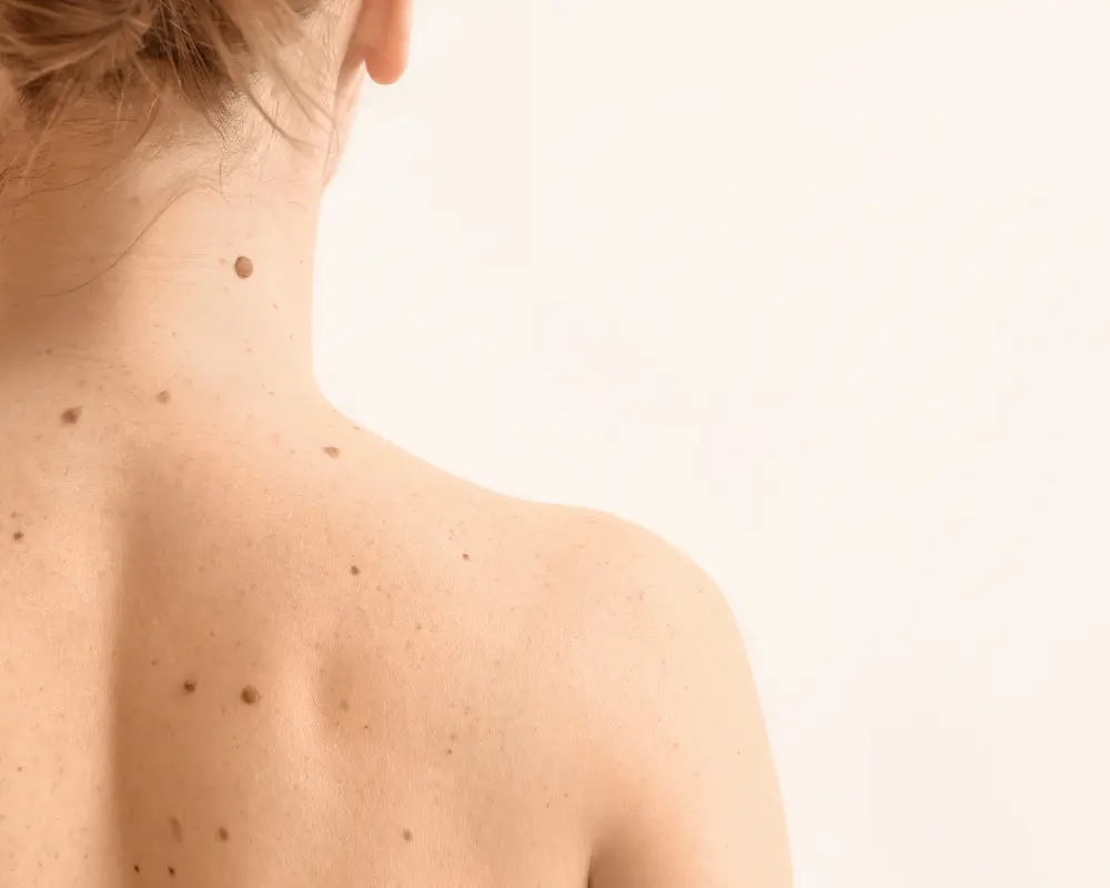 Skin Cancer Management: a practical update on BCC and SCC